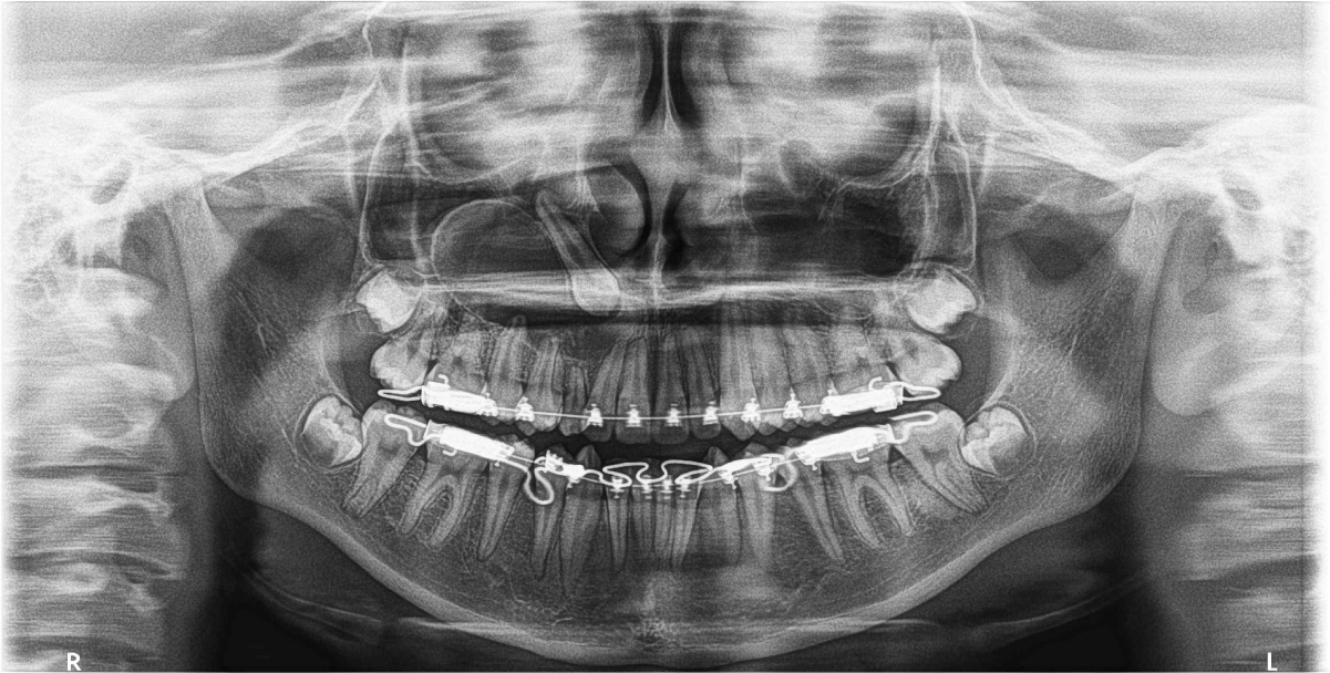 Quiste Odontogénico Calcificante Asociado A Odontoma » Dental Para Cual