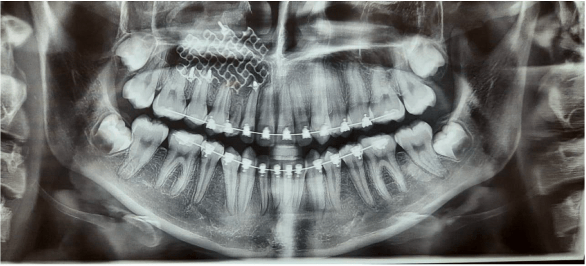 Quiste Odontogénico Calcificante Asociado A Odontoma » Dental Para Cual