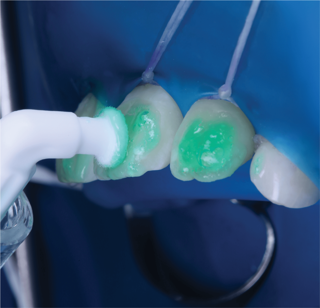 Hipomineralización Molar Incisivo, Un Reto Para El Odontólogo » Dental ...