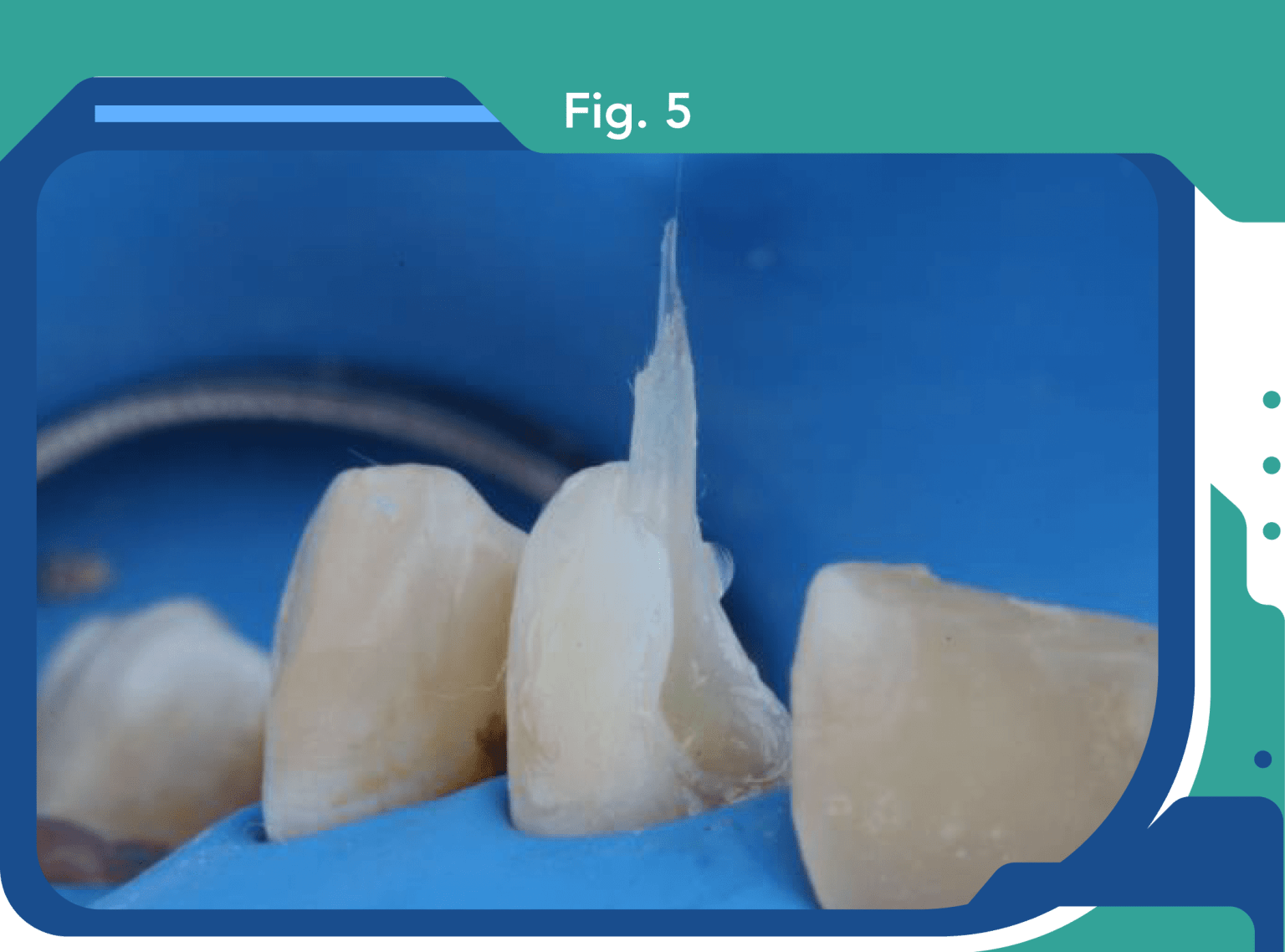 Restauración Biomimética En Dientes Tratados Endodónticamente » Dental ...