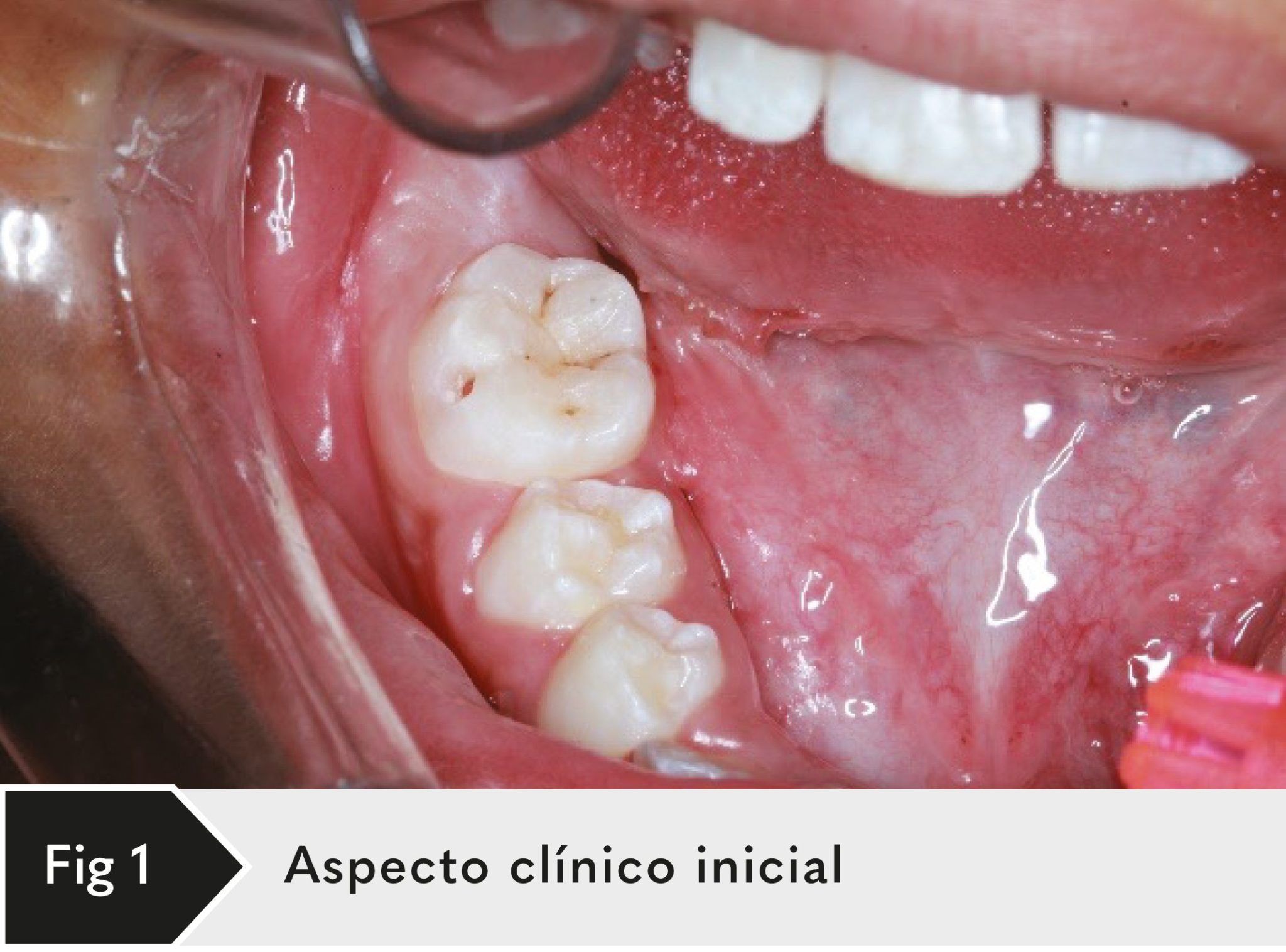 Tratamiento Microinvasivo Con Sellador Conseal F En Molares Permanentes ...