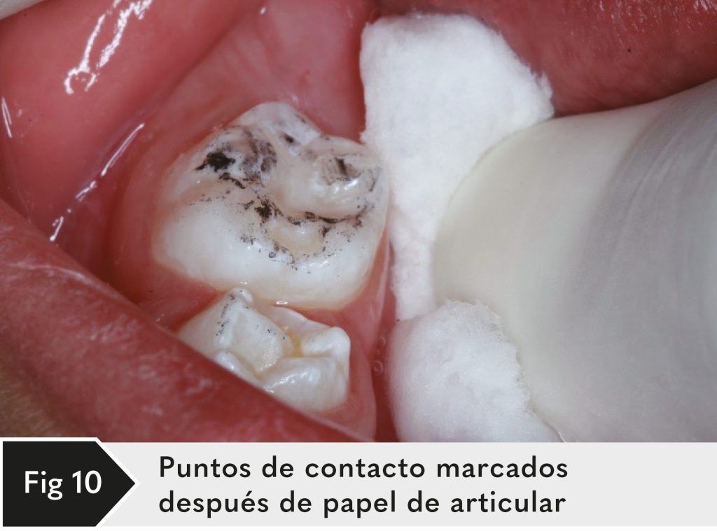 Tratamiento Microinvasivo Con Sellador Conseal F En Molares Permanentes ...