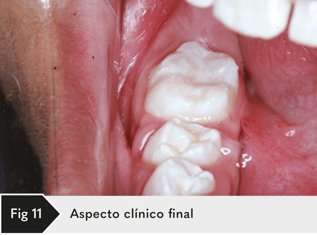 Tratamiento Microinvasivo Con Sellador Conseal F En Molares Permanentes ...