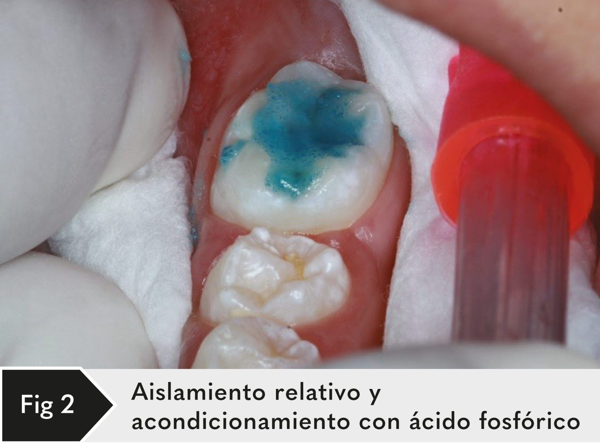 Tratamiento Microinvasivo Con Sellador Conseal F En Molares Permanentes ...