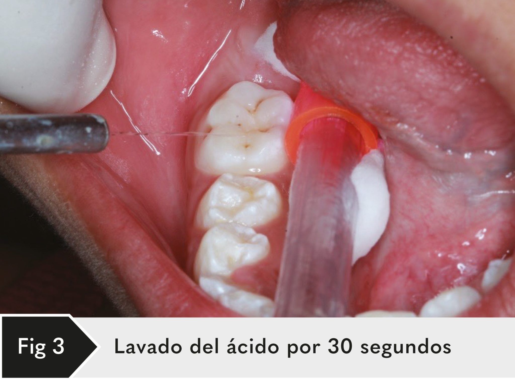 Tratamiento Microinvasivo Con Sellador Conseal F En Molares Permanentes ...