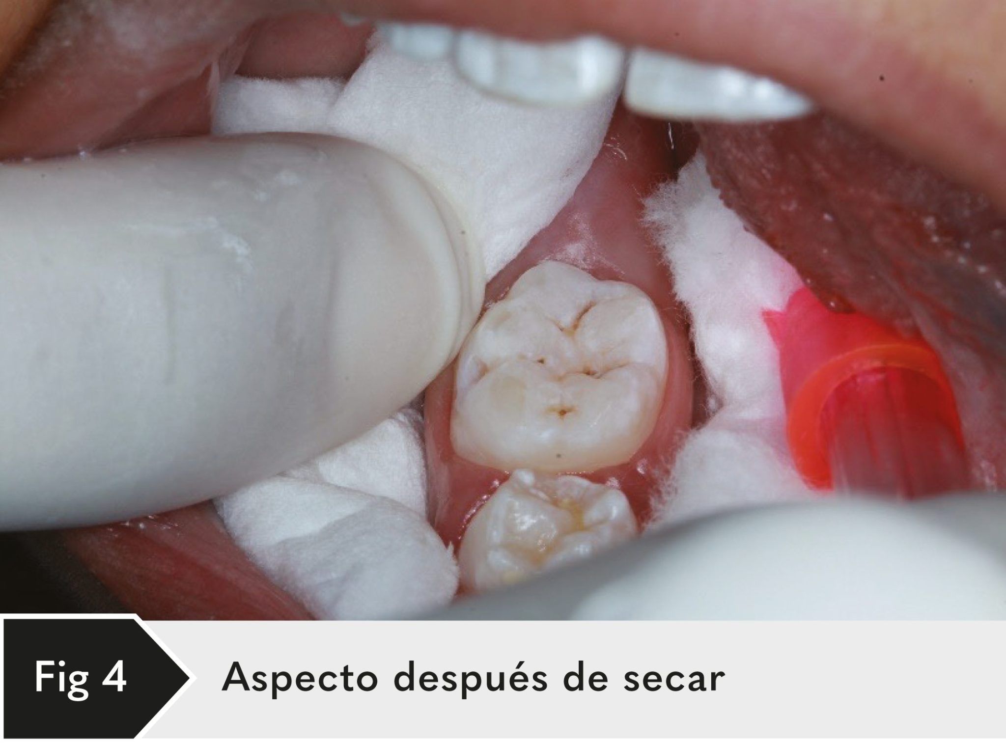 Tratamiento Microinvasivo Con Sellador Conseal F En Molares Permanentes ...