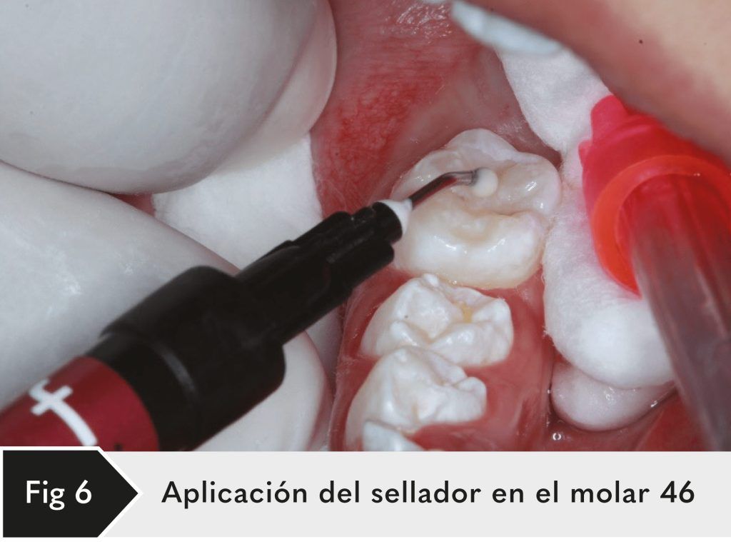 Tratamiento Microinvasivo Con Sellador Conseal F En Molares Permanentes ...