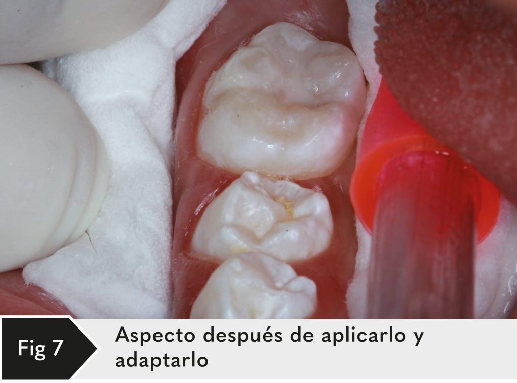 Tratamiento Microinvasivo Con Sellador Conseal F En Molares Permanentes ...