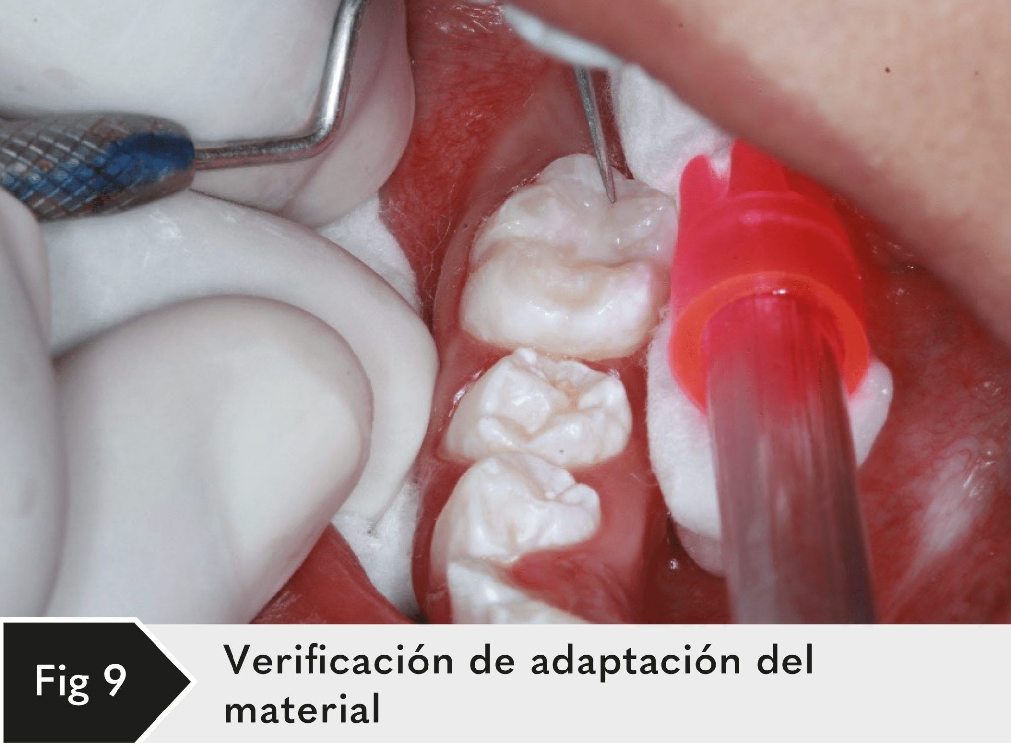 Tratamiento Microinvasivo Con Sellador Conseal F En Molares Permanentes ...