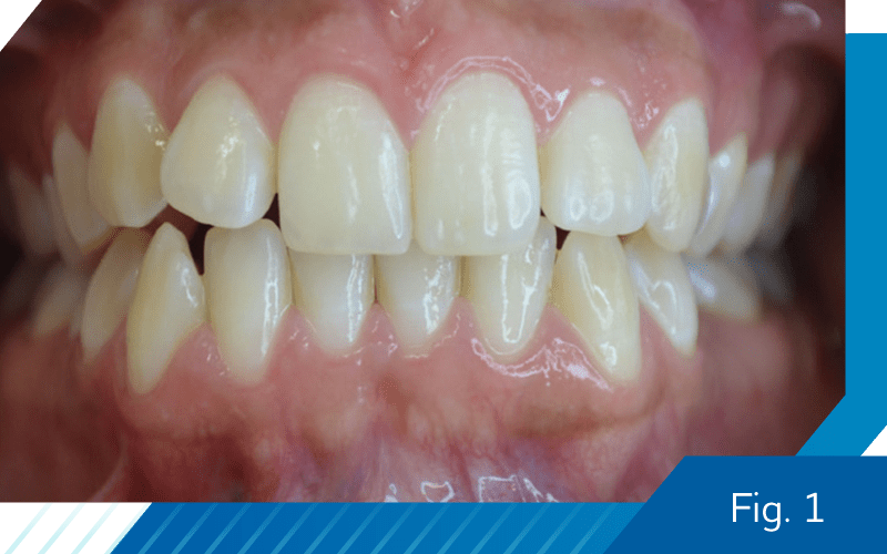 Blanqueamiento Con Pola Office Bulk Kit » Dental Para Cual