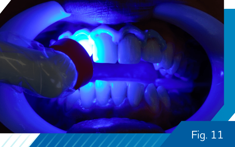 Blanqueamiento Con Pola Office Bulk Kit » Dental Para Cual