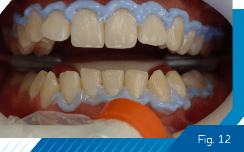 Blanqueamiento Con Pola Office Bulk Kit » Dental Para Cual