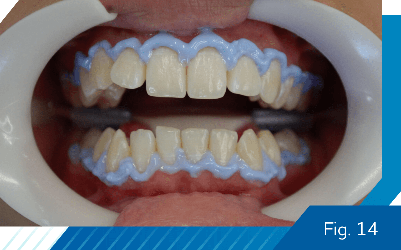 Blanqueamiento Con Pola Office Bulk Kit » Dental Para Cual