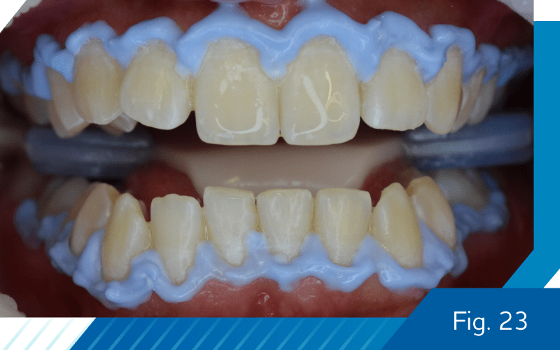 Blanqueamiento Con Pola Office Bulk Kit » Dental Para Cual