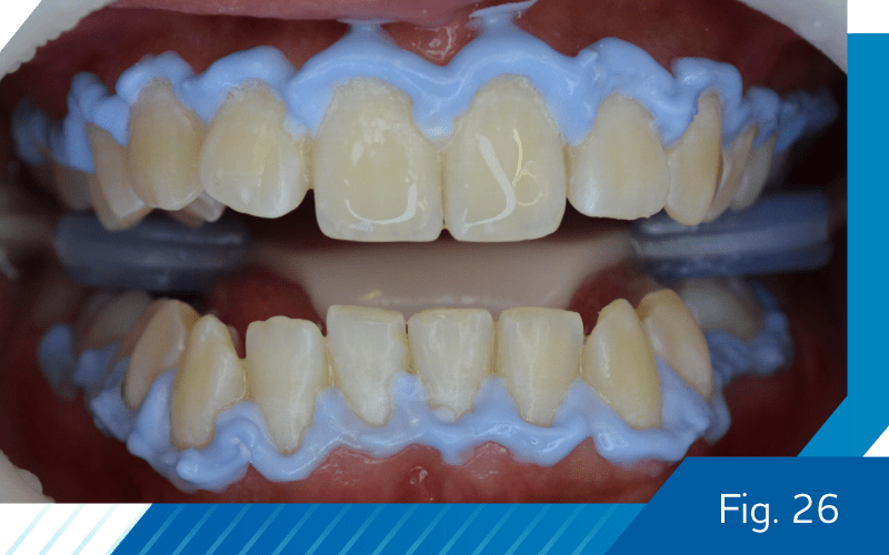 Blanqueamiento Con Pola Office Bulk Kit » Dental Para Cual