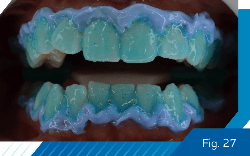 Blanqueamiento Con Pola Office Bulk Kit » Dental Para Cual