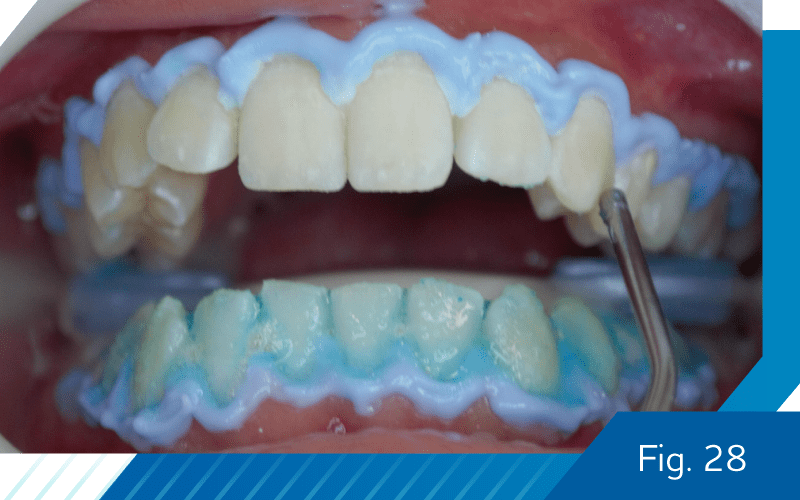 Blanqueamiento Con Pola Office Bulk Kit » Dental Para Cual