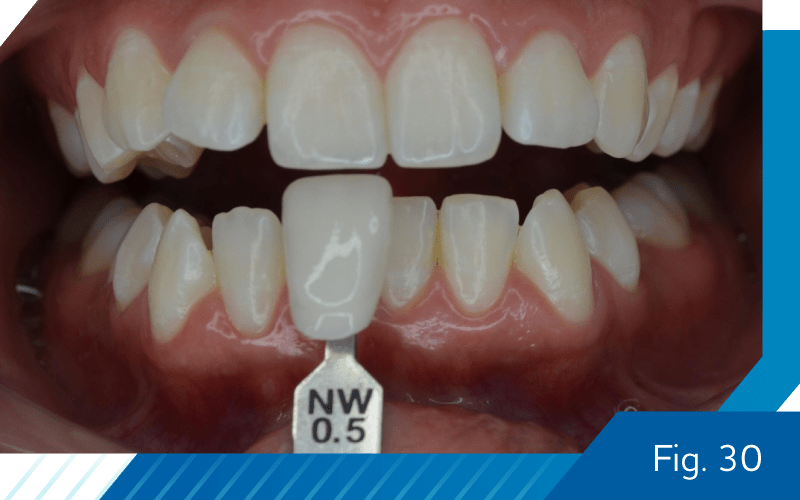 Blanqueamiento Con Pola Office Bulk Kit » Dental Para Cual