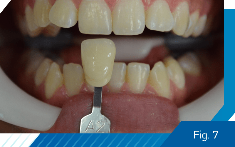 Blanqueamiento Con Pola Office Bulk Kit » Dental Para Cual