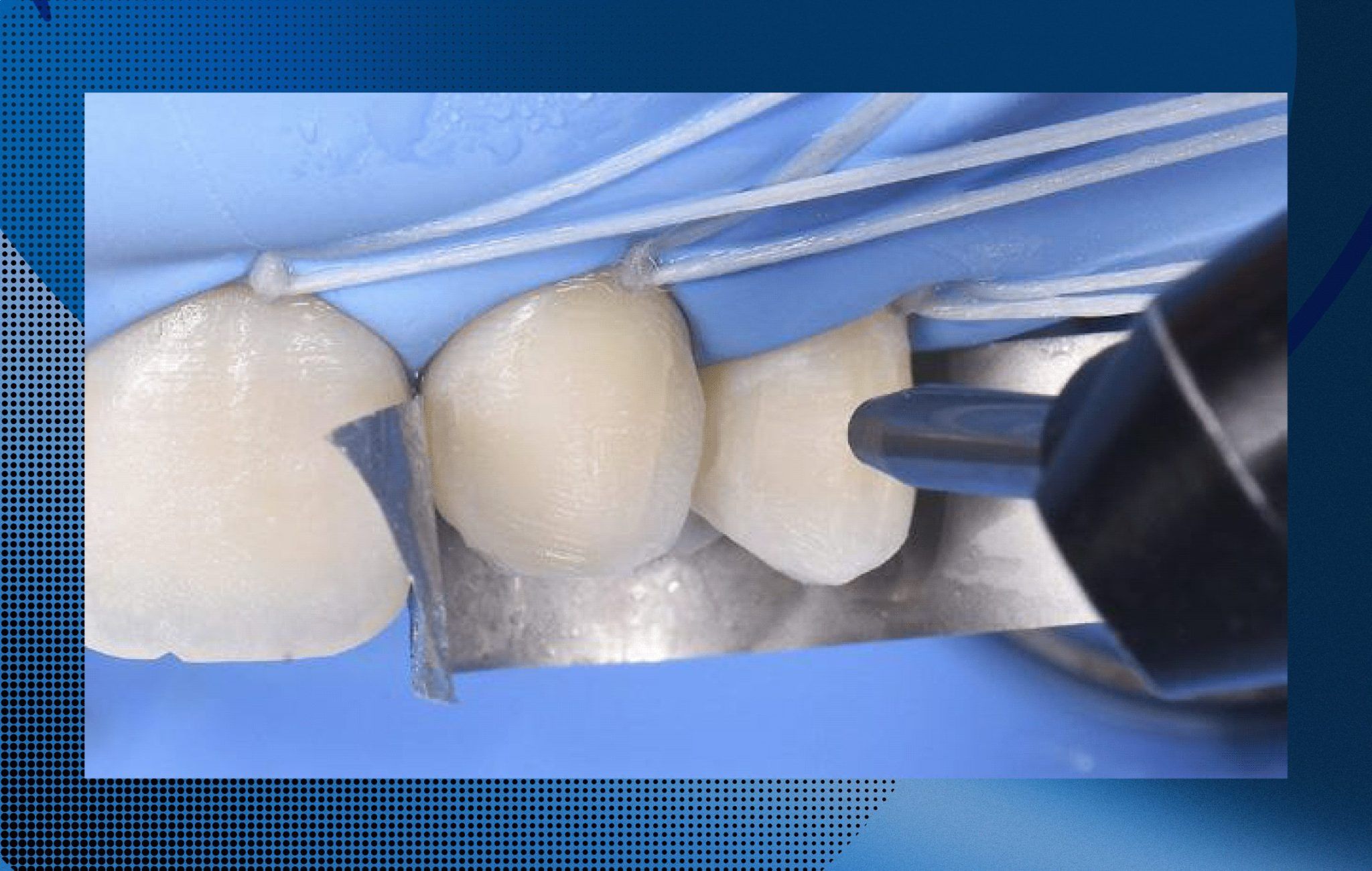 Cambio De Sonrisa Ecosite Elements » Dental Para Cual