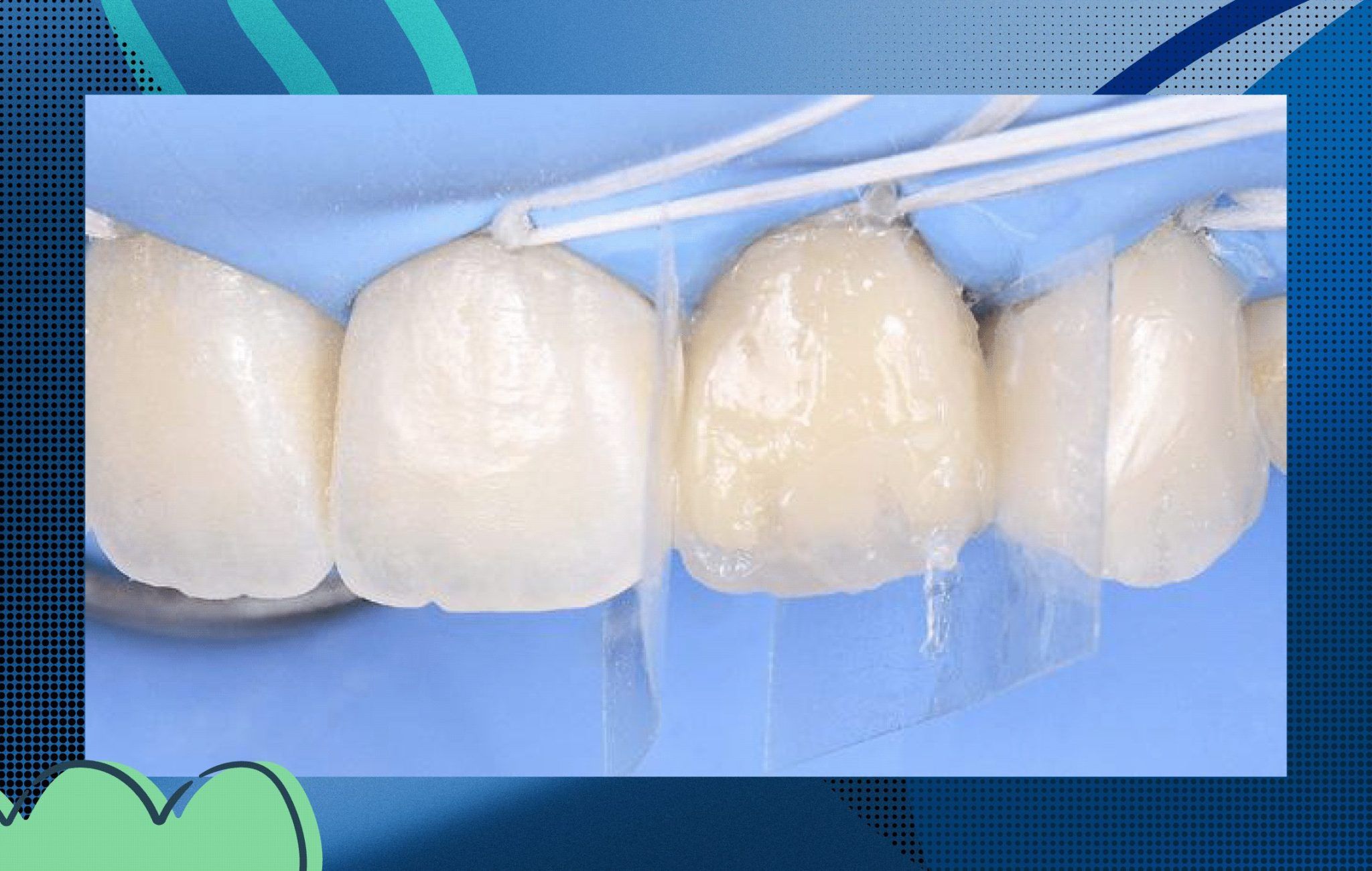 Cambio De Sonrisa Ecosite Elements » Dental Para Cual
