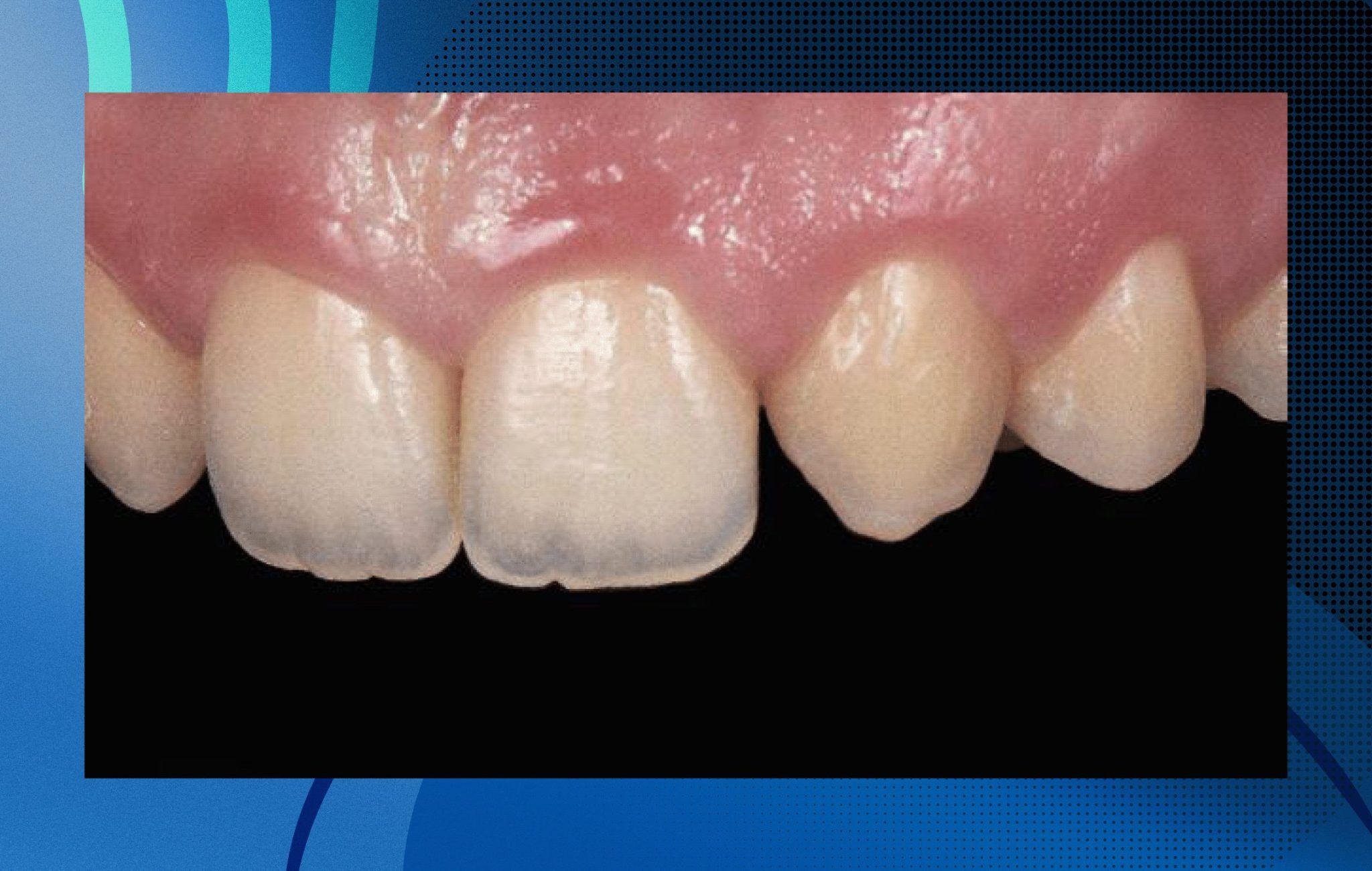 Cambio De Sonrisa Ecosite Elements » Dental Para Cual
