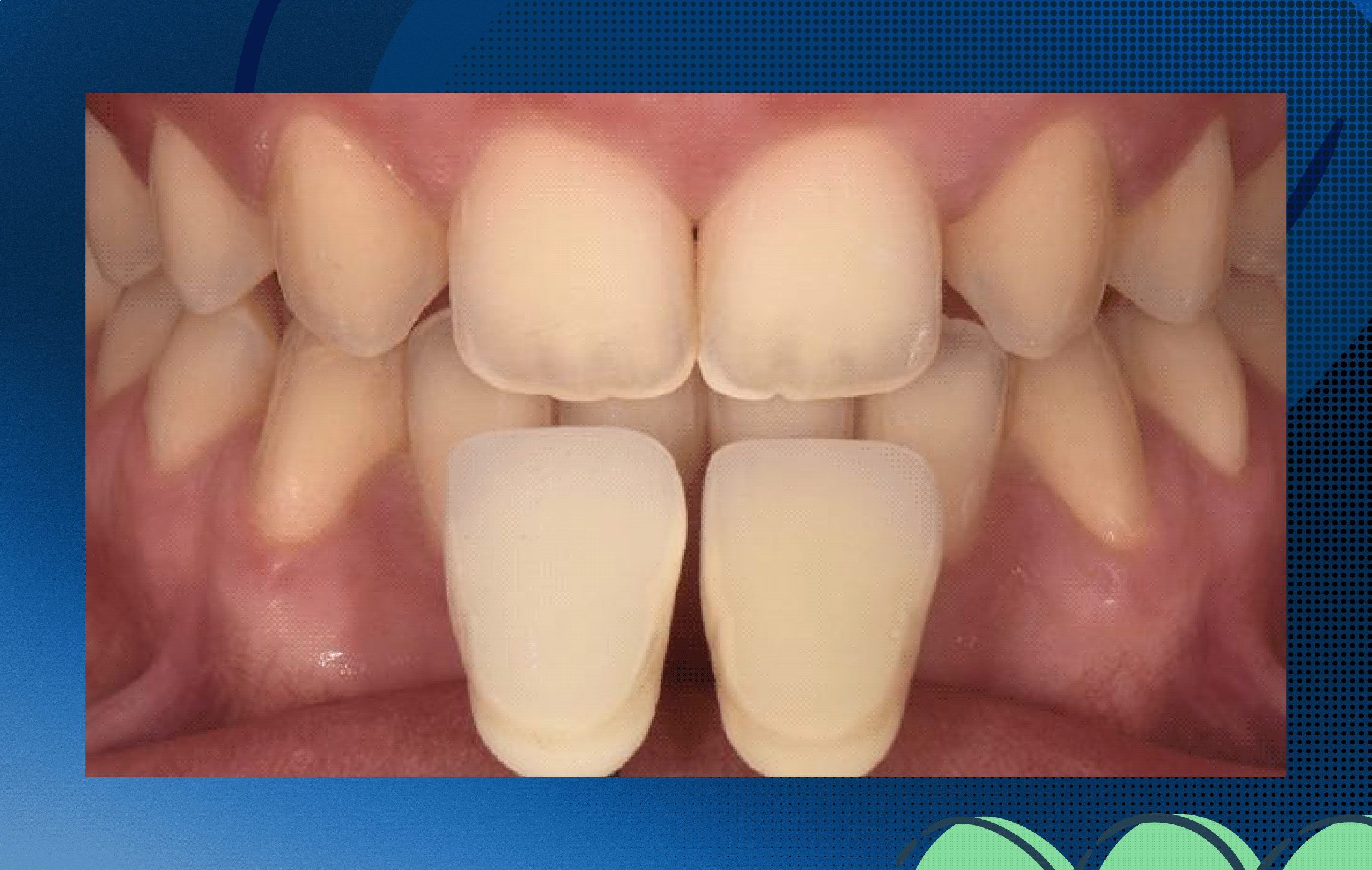 Cambio De Sonrisa Ecosite Elements » Dental Para Cual