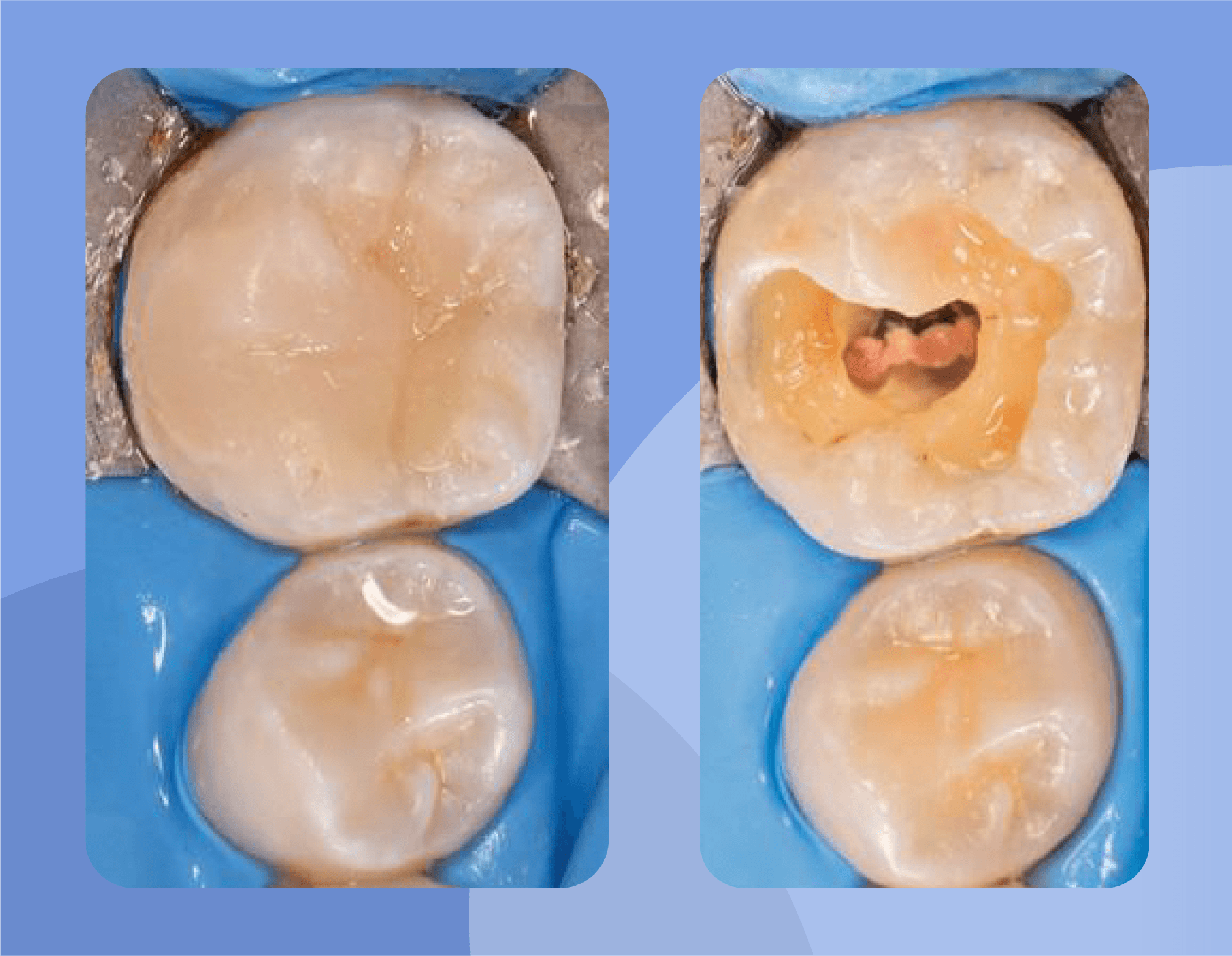 Ecosite Elements De DMG » Dental Para Cual