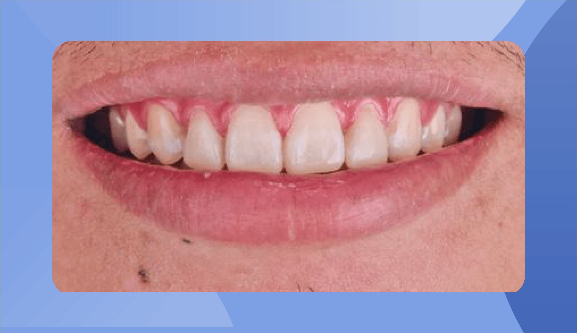 Ecosite Elements De DMG » Dental Para Cual