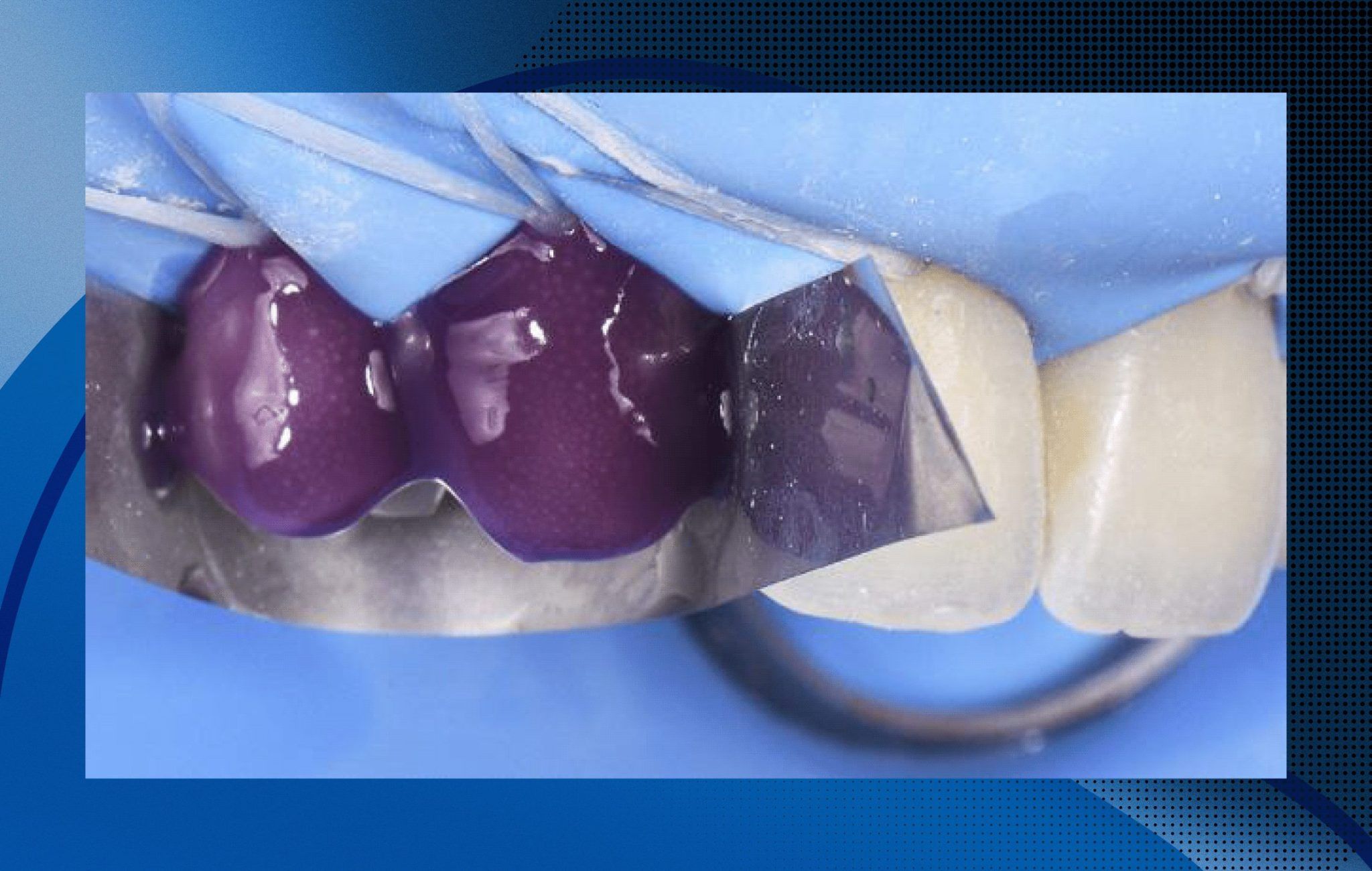 Cambio De Sonrisa Ecosite Elements » Dental Para Cual