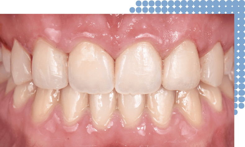 Cambio De Sonrisa Mediante El Uso De Ecosite Elements » Dental Para Cual
