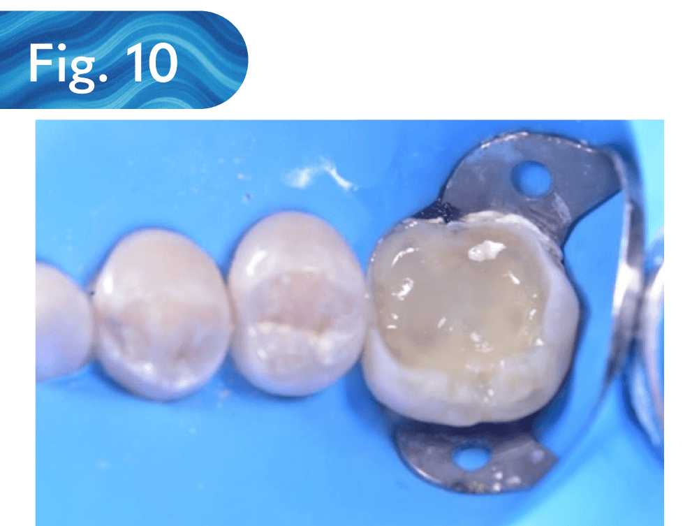 Reconstrucción Posendodóntica, Protocolo Biomimético Con Restauración ...