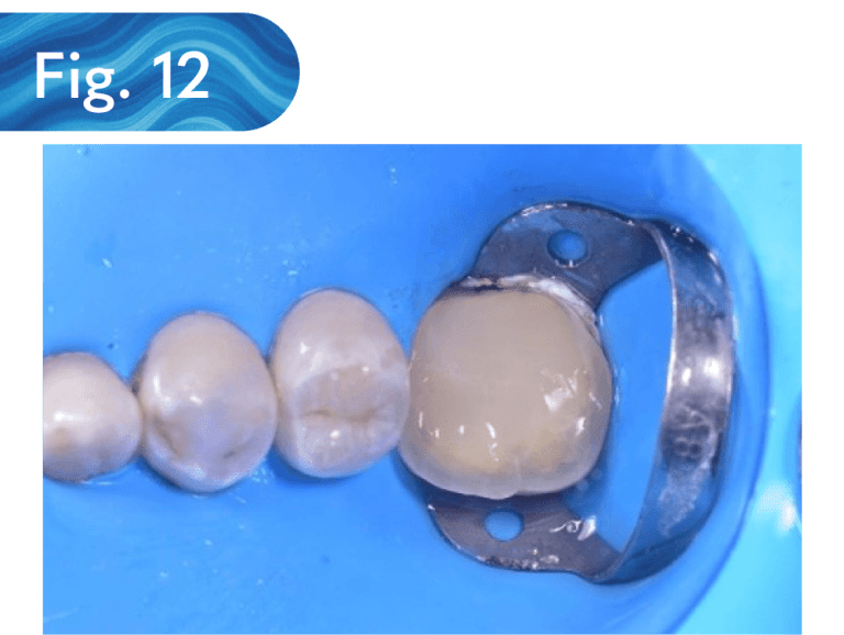 Reconstrucción Posendodóntica, Protocolo Biomimético Con Restauración ...
