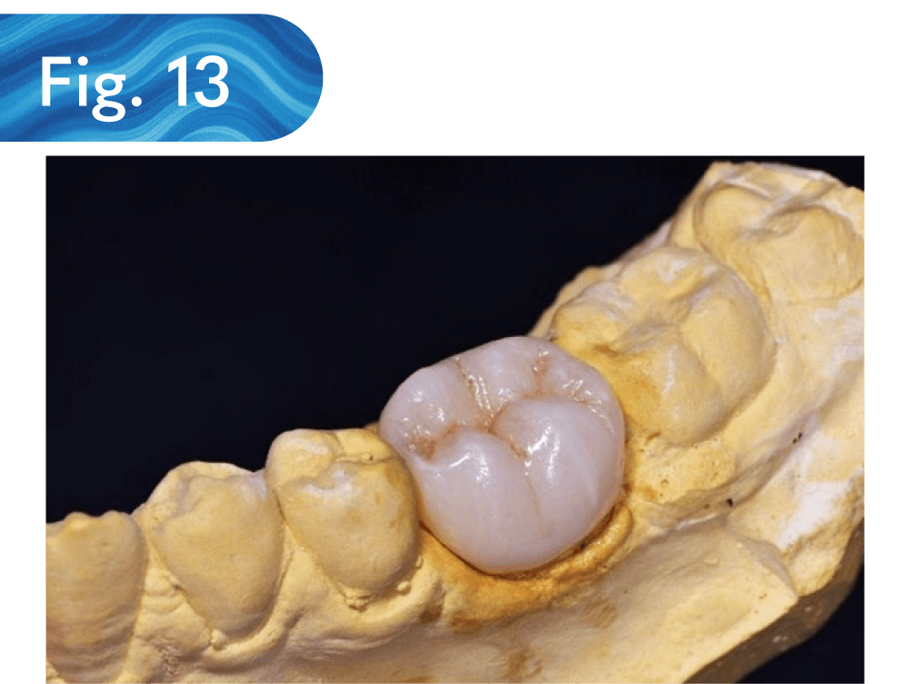 Reconstrucción Posendodóntica, Protocolo Biomimético Con Restauración ...