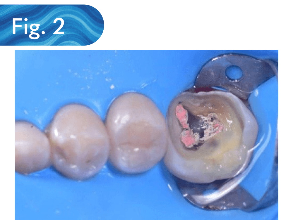 Reconstrucción Posendodóntica, Protocolo Biomimético Con Restauración ...