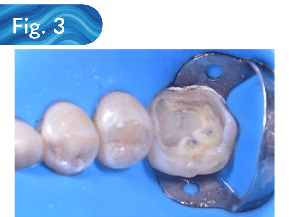 Reconstrucción Posendodóntica, Protocolo Biomimético Con Restauración ...