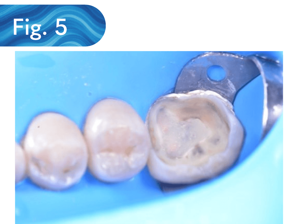 Reconstrucción Posendodóntica, Protocolo Biomimético Con Restauración ...