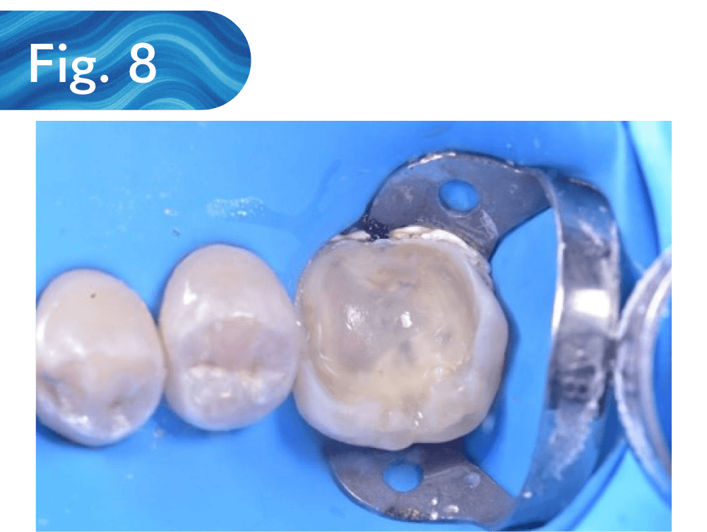 Reconstrucción Posendodóntica, Protocolo Biomimético Con Restauración ...
